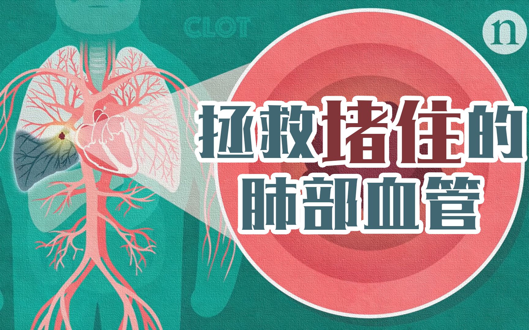 肺栓塞的治疗方法【Nature 自然科研】