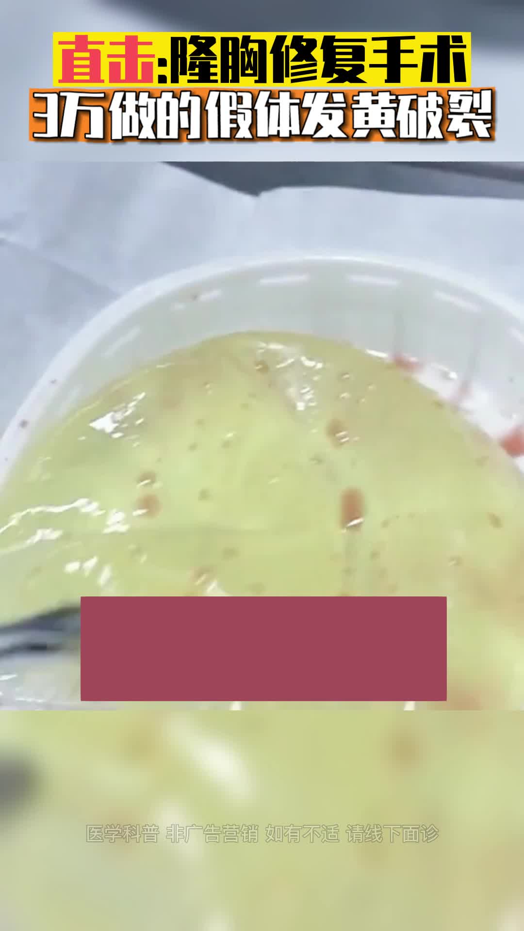 隆胸假体会破裂?一般是去不正规诊所做的劣质假体!只要不出问题就...