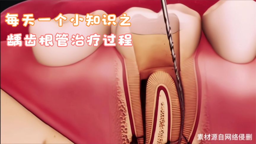根管治疗全程,看完要好好保护牙齿吗