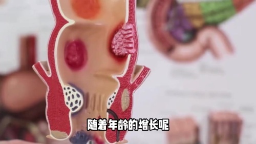痔疮--对号入座,看看你为什么会得痔疮