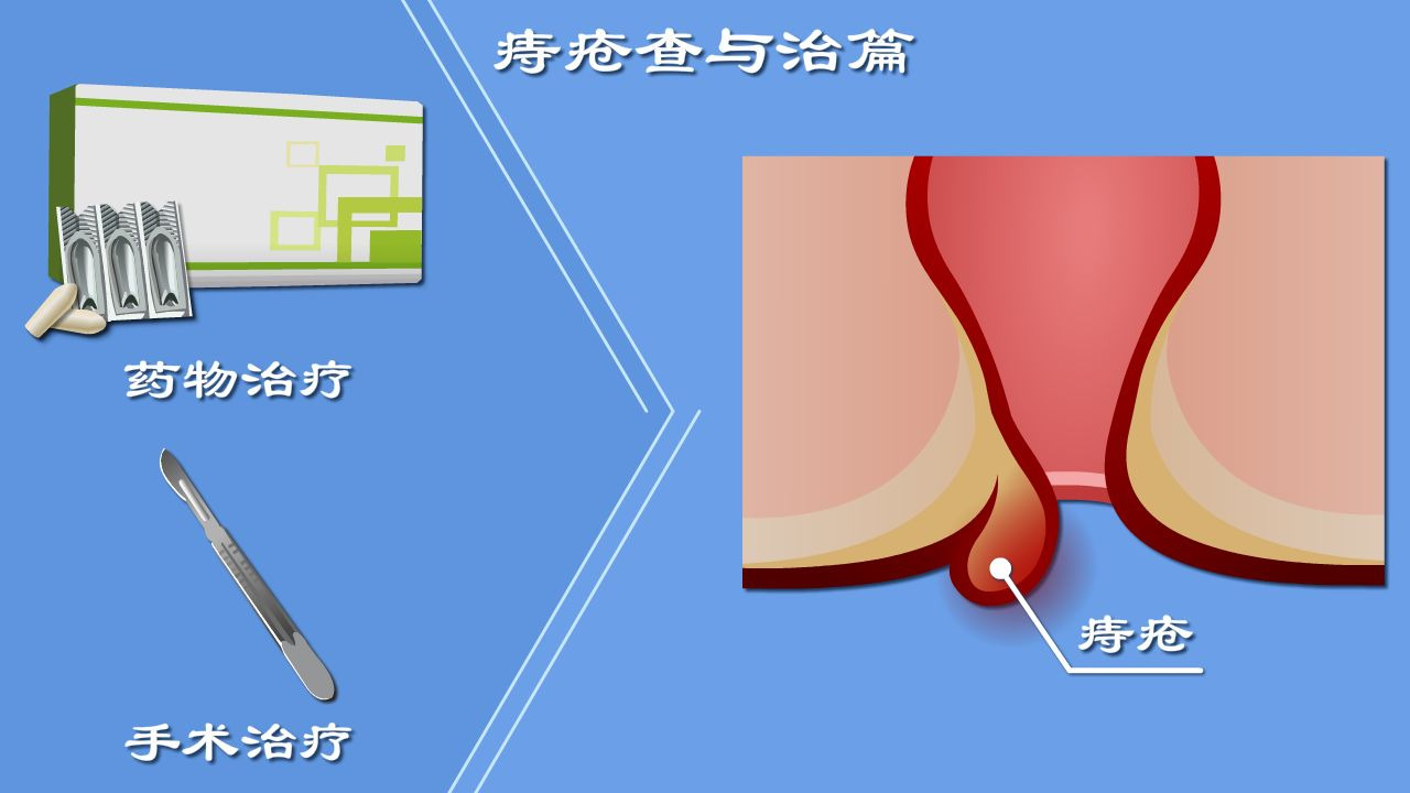 痔疮4:最带感的菊花保健操
