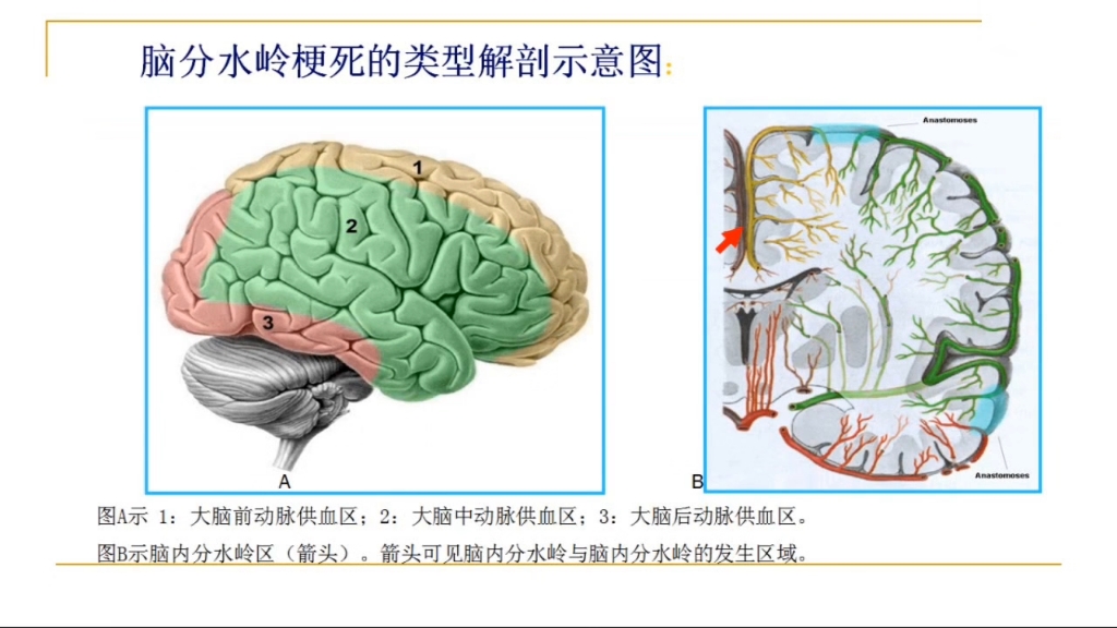 ...中枢神经系统临床应用共65讲06:分水岭脑梗死病因与临床表现-唐伟