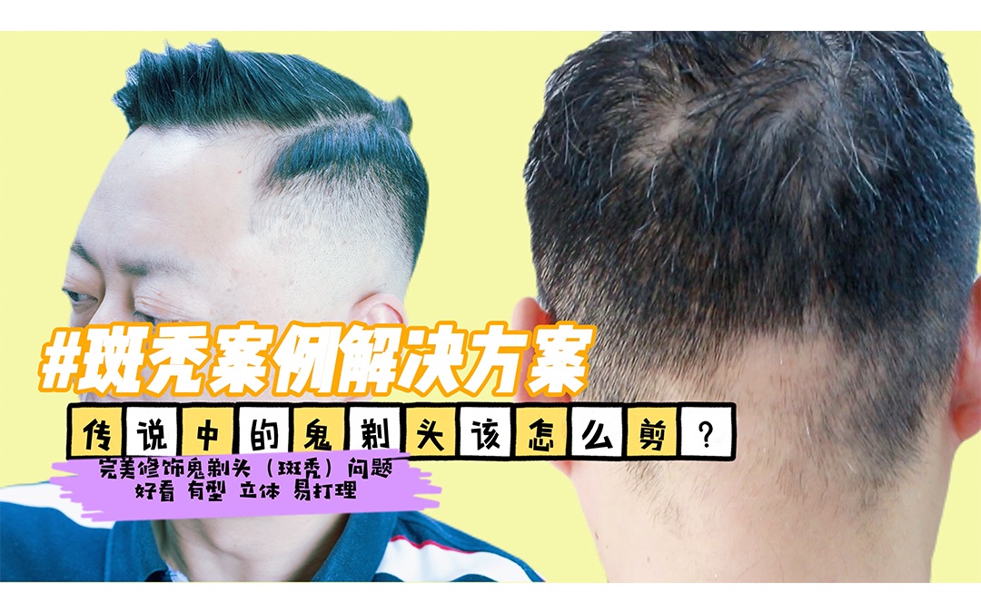 ...什么是鬼剃头? 鬼剃头就是出现大面积掉发形成大小不一 形状不规则...