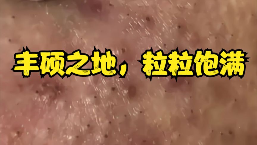 小哥皮肤有问题,粉刺针挑帮到你