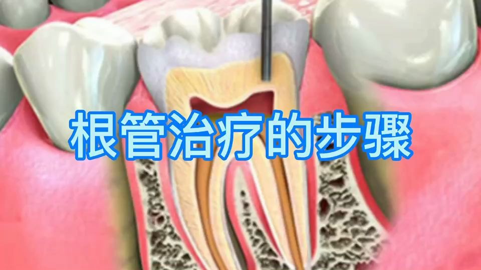 让人闻风丧胆的根管治疗,具体的步骤是如何的?了解它,才不会畏惧它