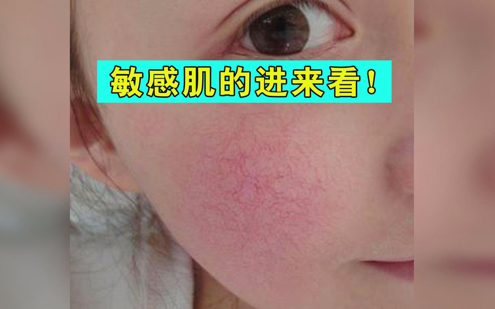 敏感性肌肤该怎样护理?为了自己的面子千万不敢瞎折腾了!