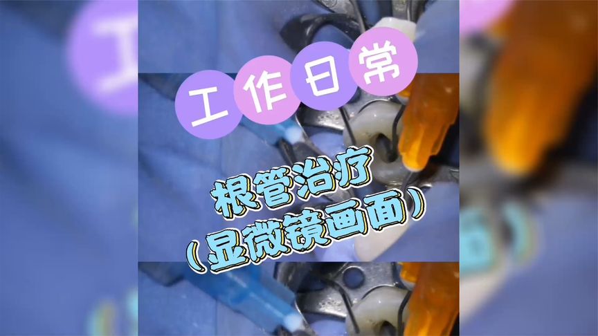工作日常-根管治疗(显微镜画面)你们见过这样的画面吗