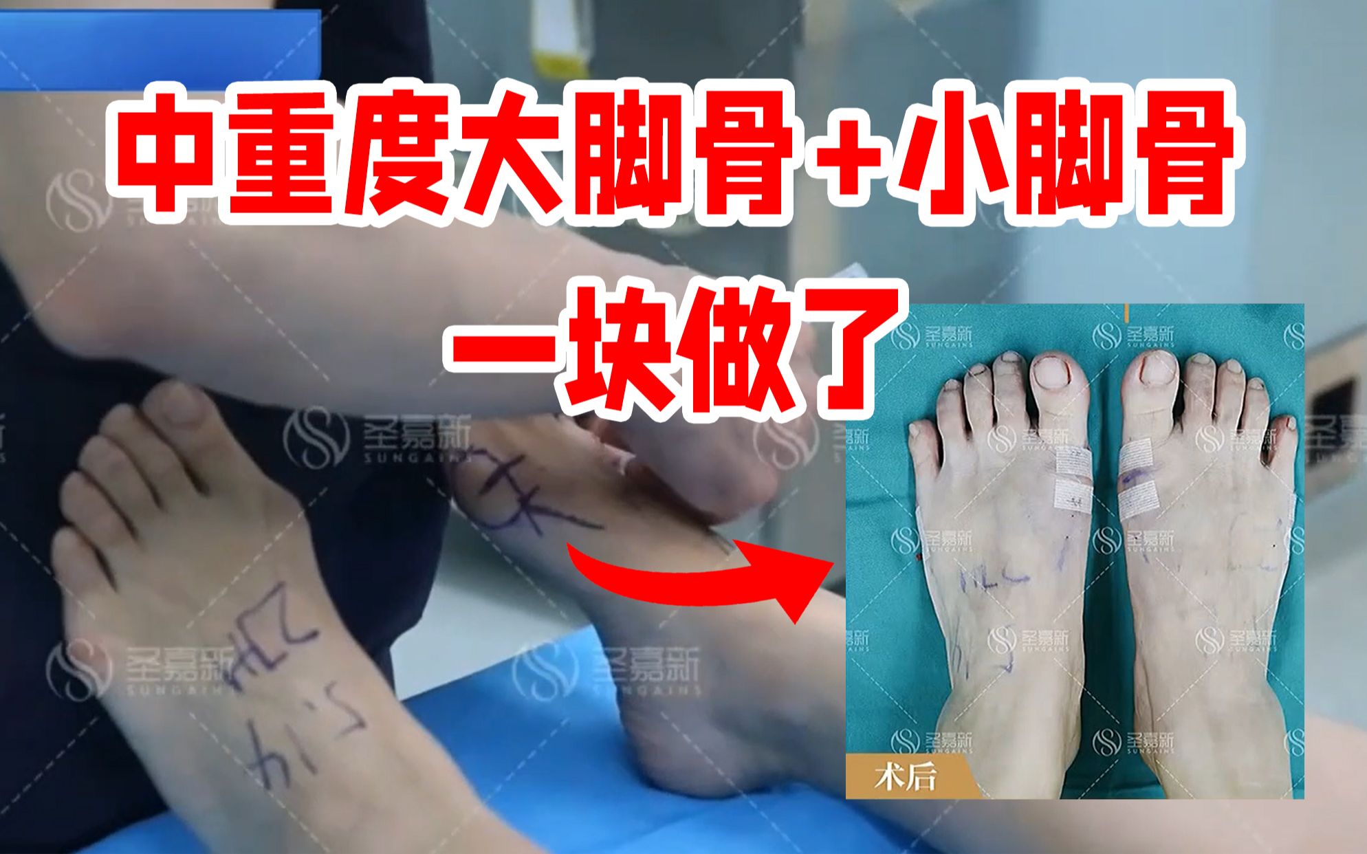 北京苏敬达医生:60岁阿姨,大脚骨+小脚骨联合治疗,外观好看了!走路不...