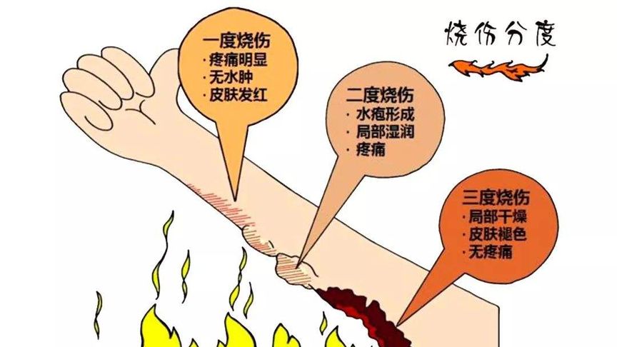 科普 | 烧伤级别划分,这些因素决定了烧伤程度!