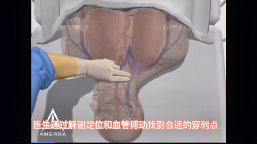 为了输注化疗药和快速补液需要在中心静脉置管,看着都疼!
