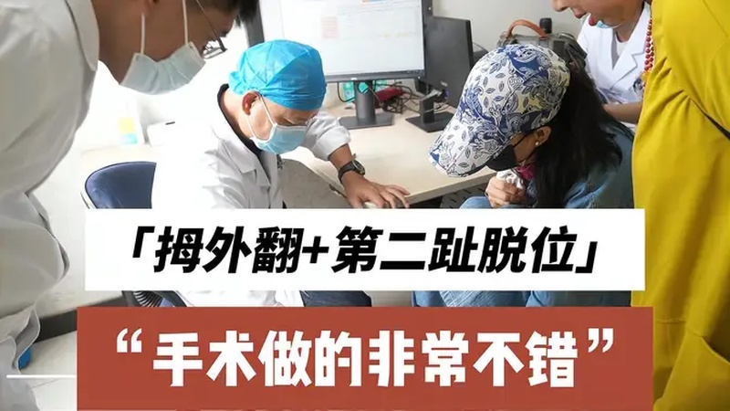 拇外翻+第二趾脱位,手术做得非常不错,现在另一只脚也要做手术
