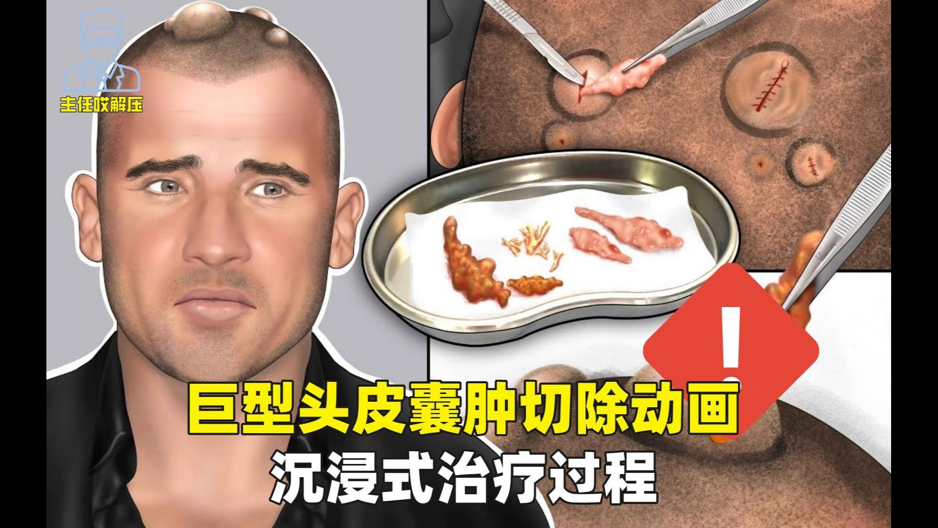 解压动画,巨型头皮囊肿切除动画,二月精彩解压动画合集