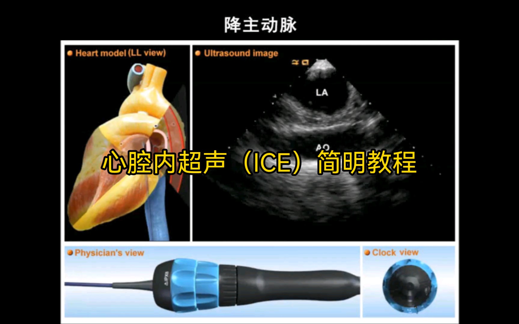 心腔内超声(ICE)简明教程