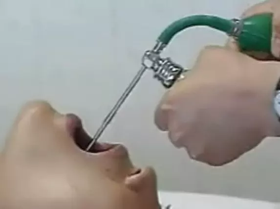 气管插管术(卫生部教材)