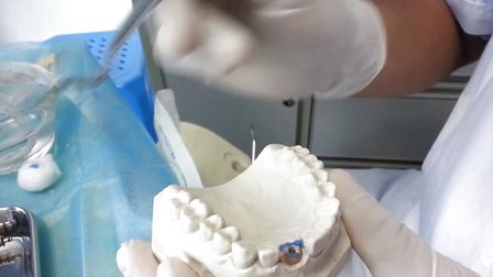 铸造桩核冠的制作