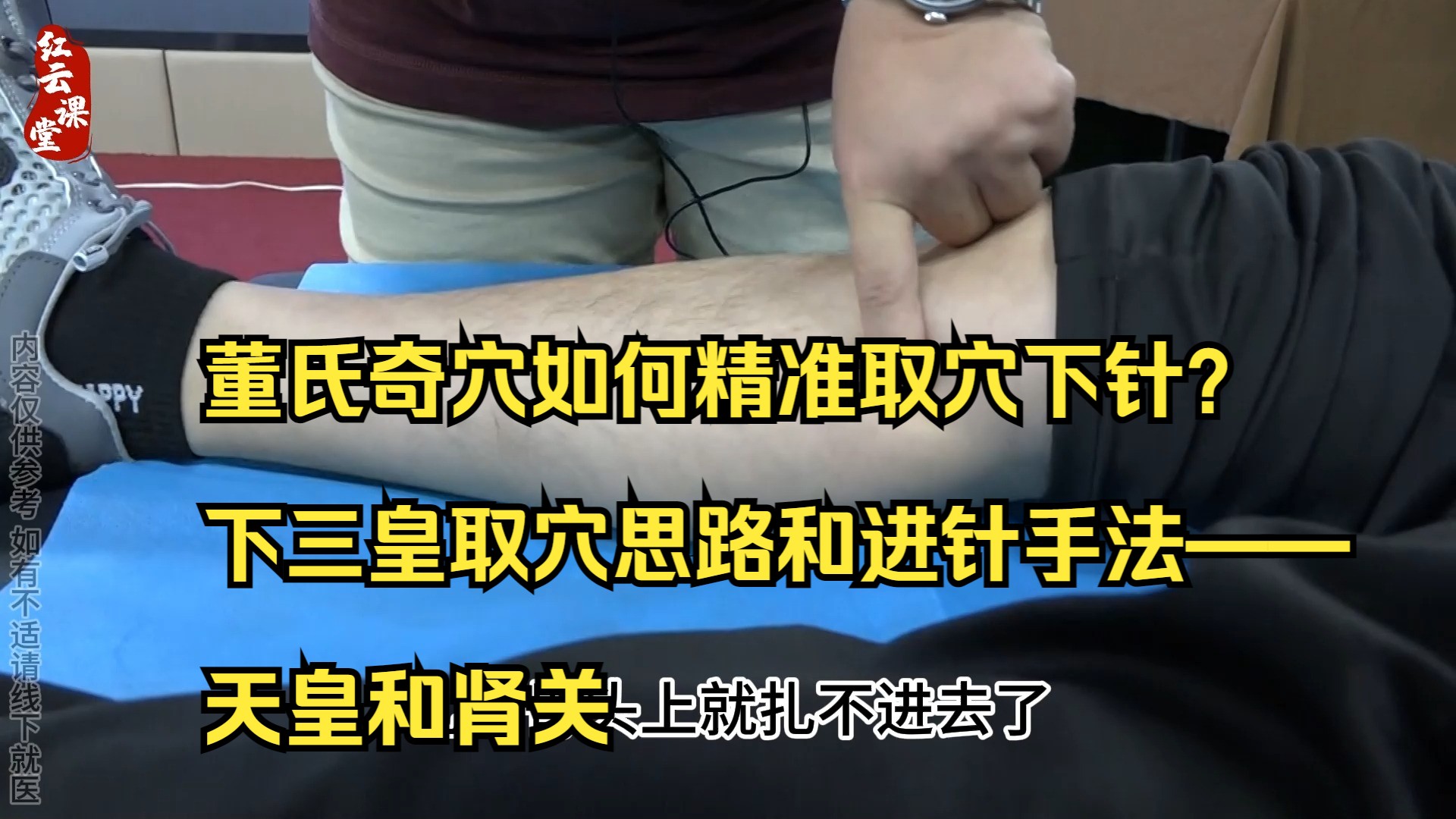 董氏奇穴如何精准取穴下针?刘红云讲下三皇取穴思路和进针手法——...