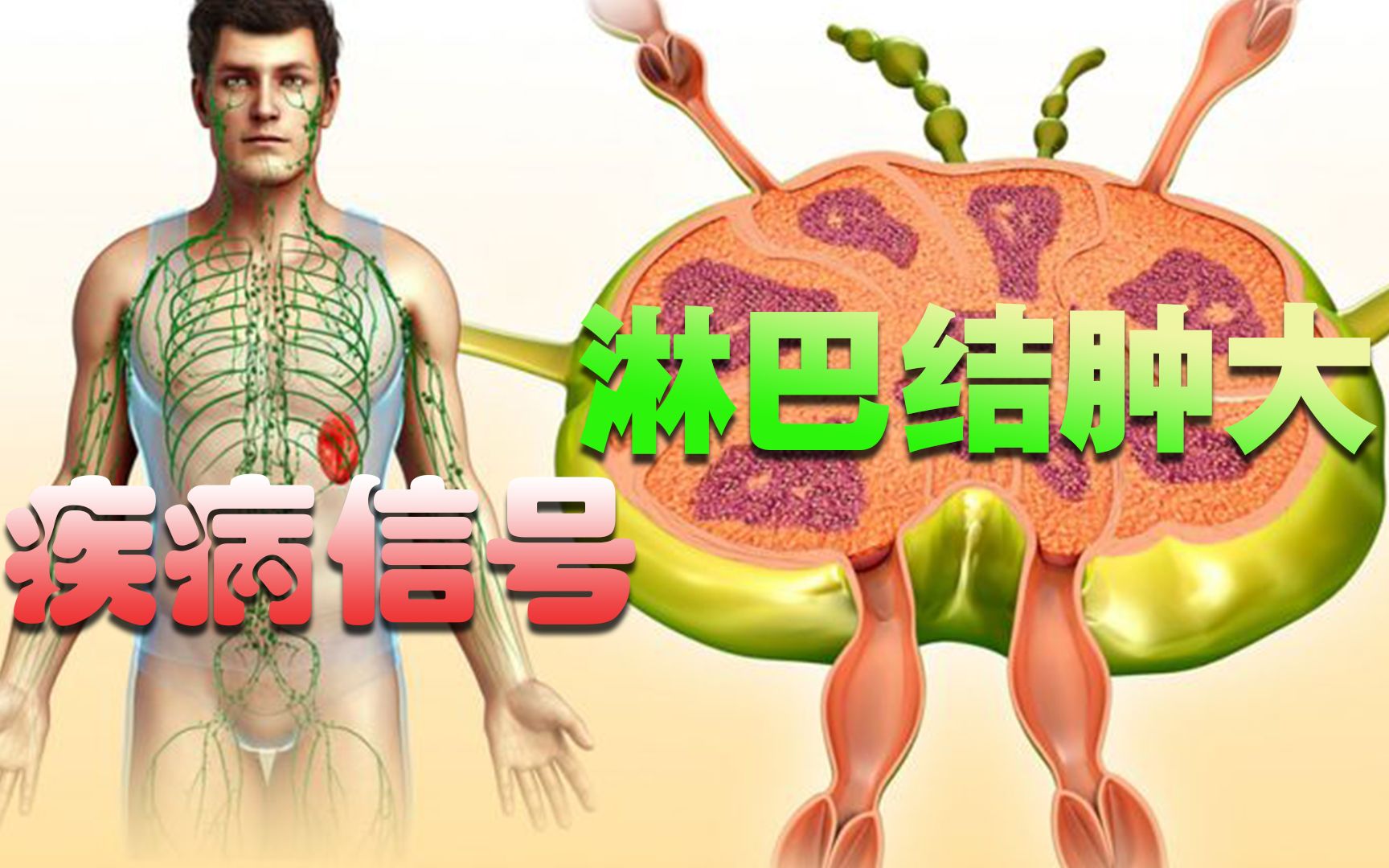 人体的疾病探测器淋巴结,肿大了预示哪些疾病信号?