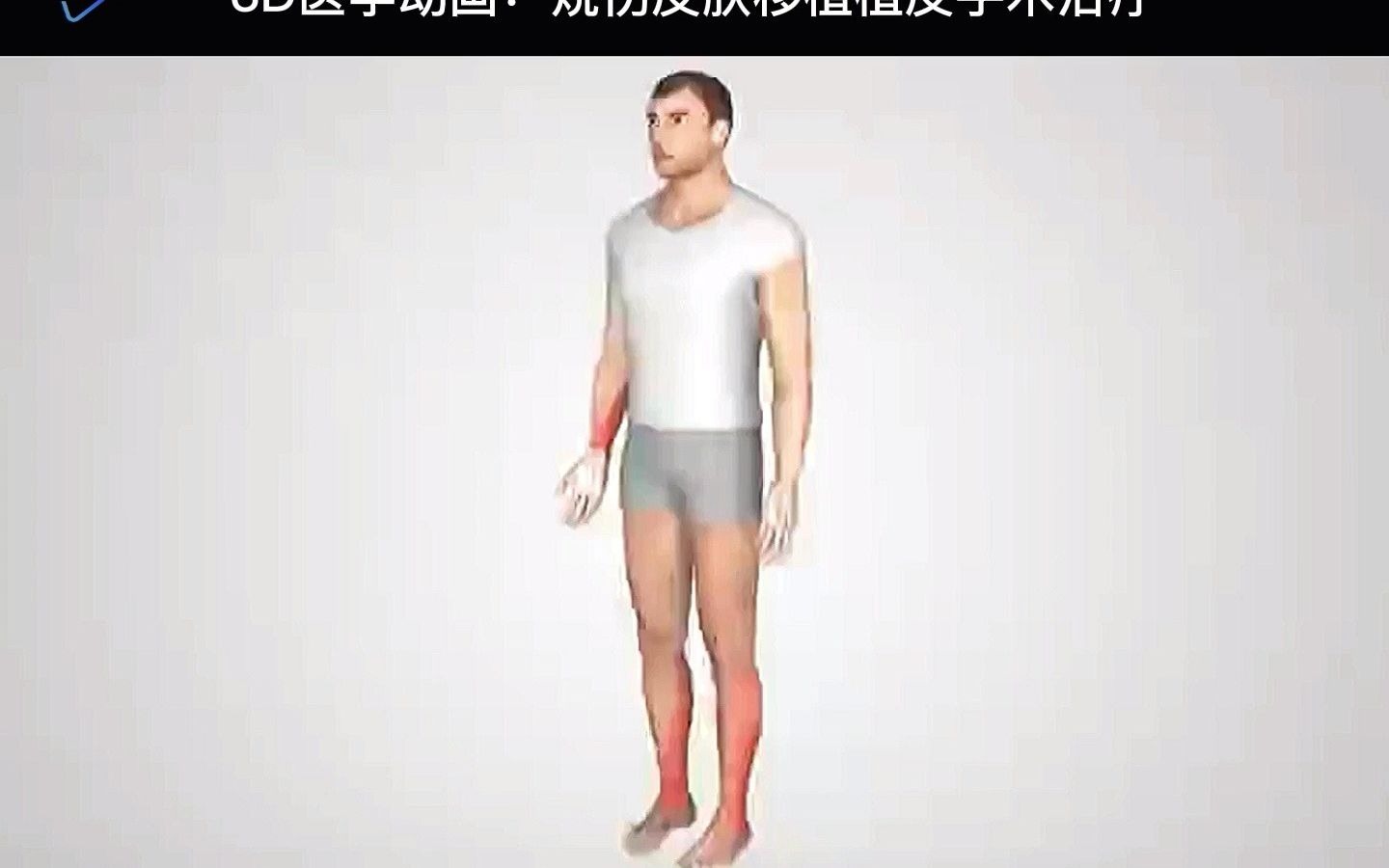 3D医学动画:烧伤皮肤移植植皮手术治疗