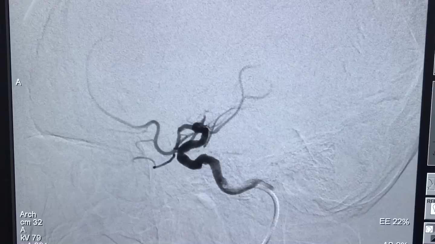 兄弟科室刚做完的脑血管造影。