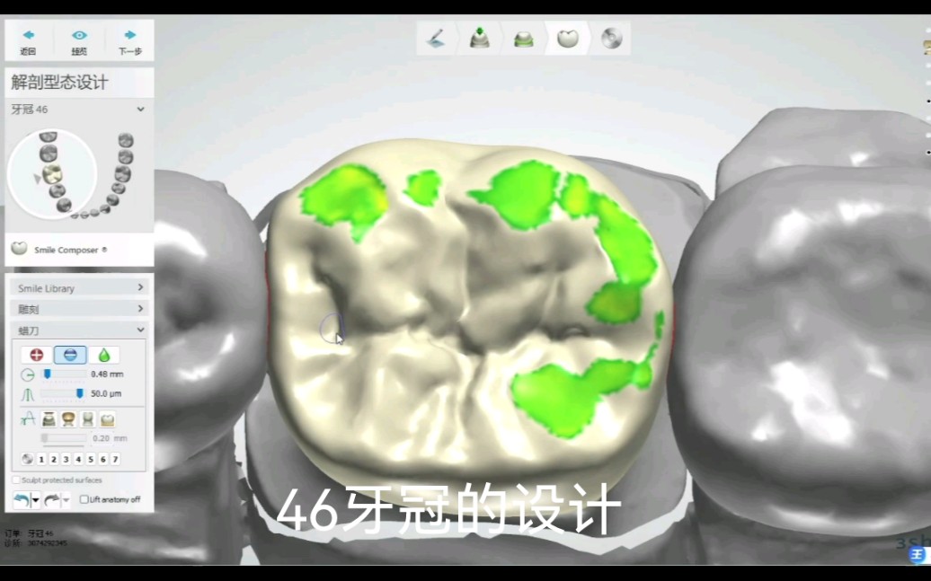 46牙冠的设计