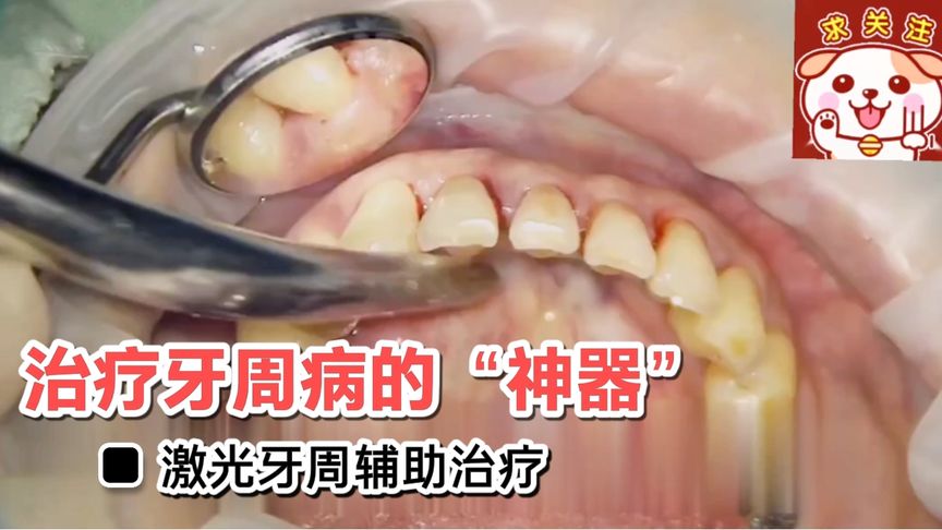 治疗牙周病的“神器”来了——激光牙周辅助治疗,能否药到病除?