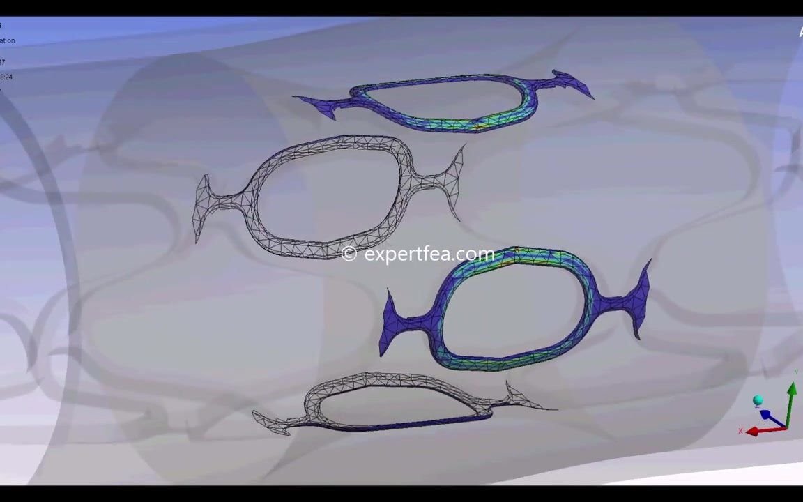 基于ANSYS 的血管支架扩张模拟