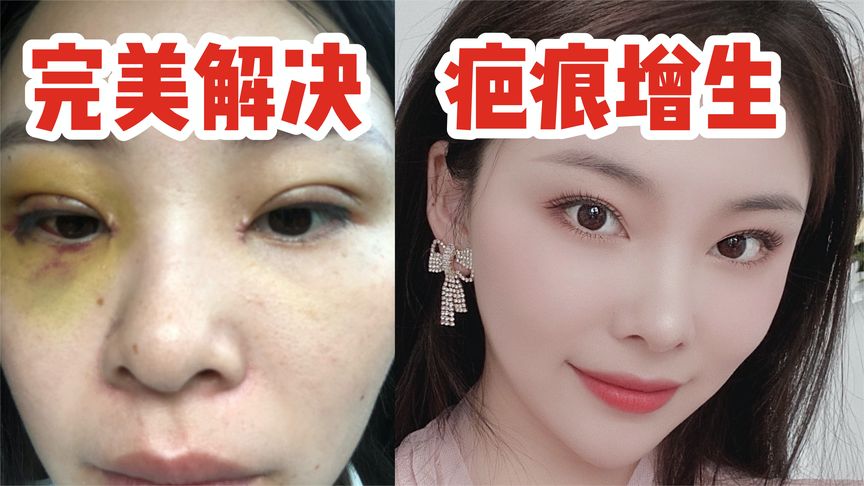 保姆级教程!手把手教你如何去除疤痕增生!