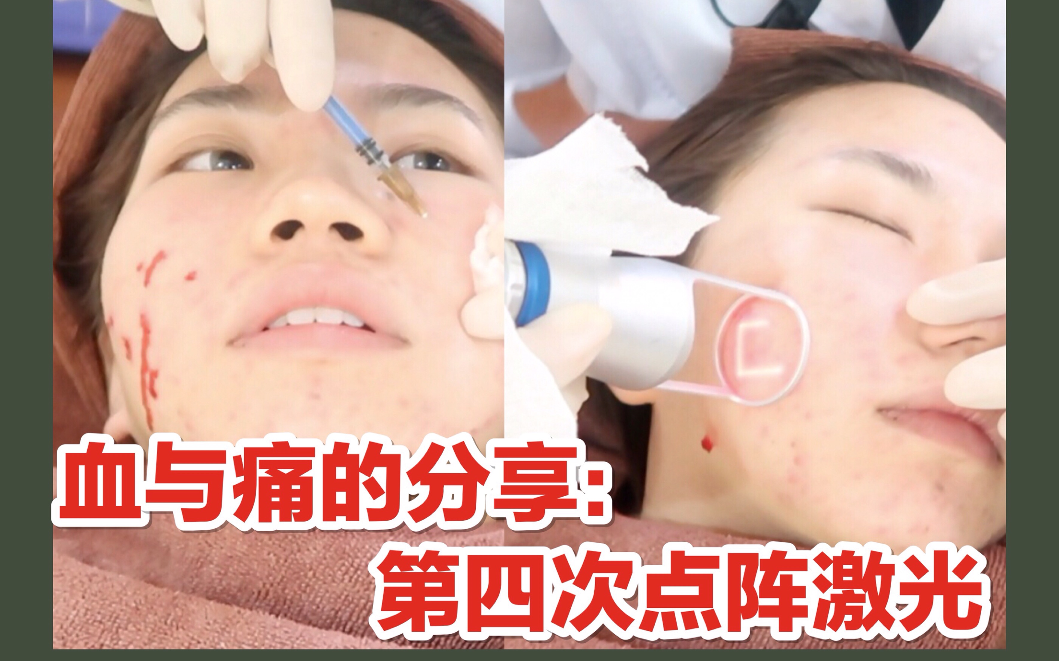 血与泪的教训!微整形医美vlog:点阵激光&切痣分享