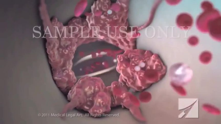 肺栓塞3D动画科普,后面有讲症状和预防措施#科普一下# @头条健康