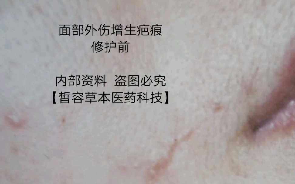 面部外伤增生疤痕,修护前后效果对比。经过《皙容草本中医药疤痕...