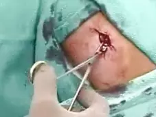 皮肤外科缝合录像