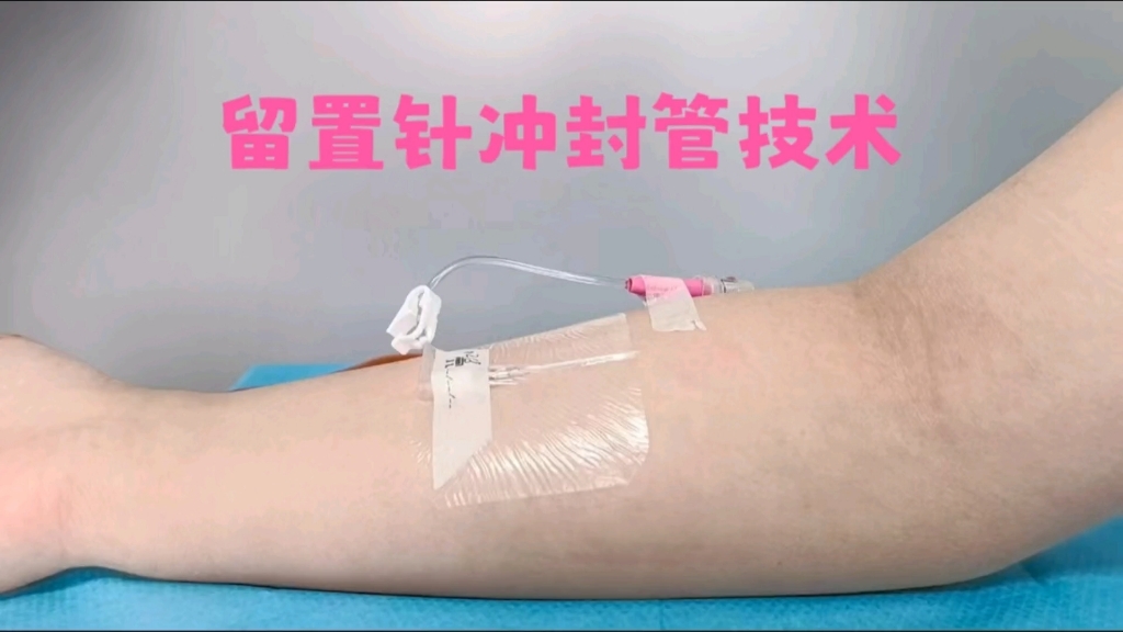 留置针冲封管技术