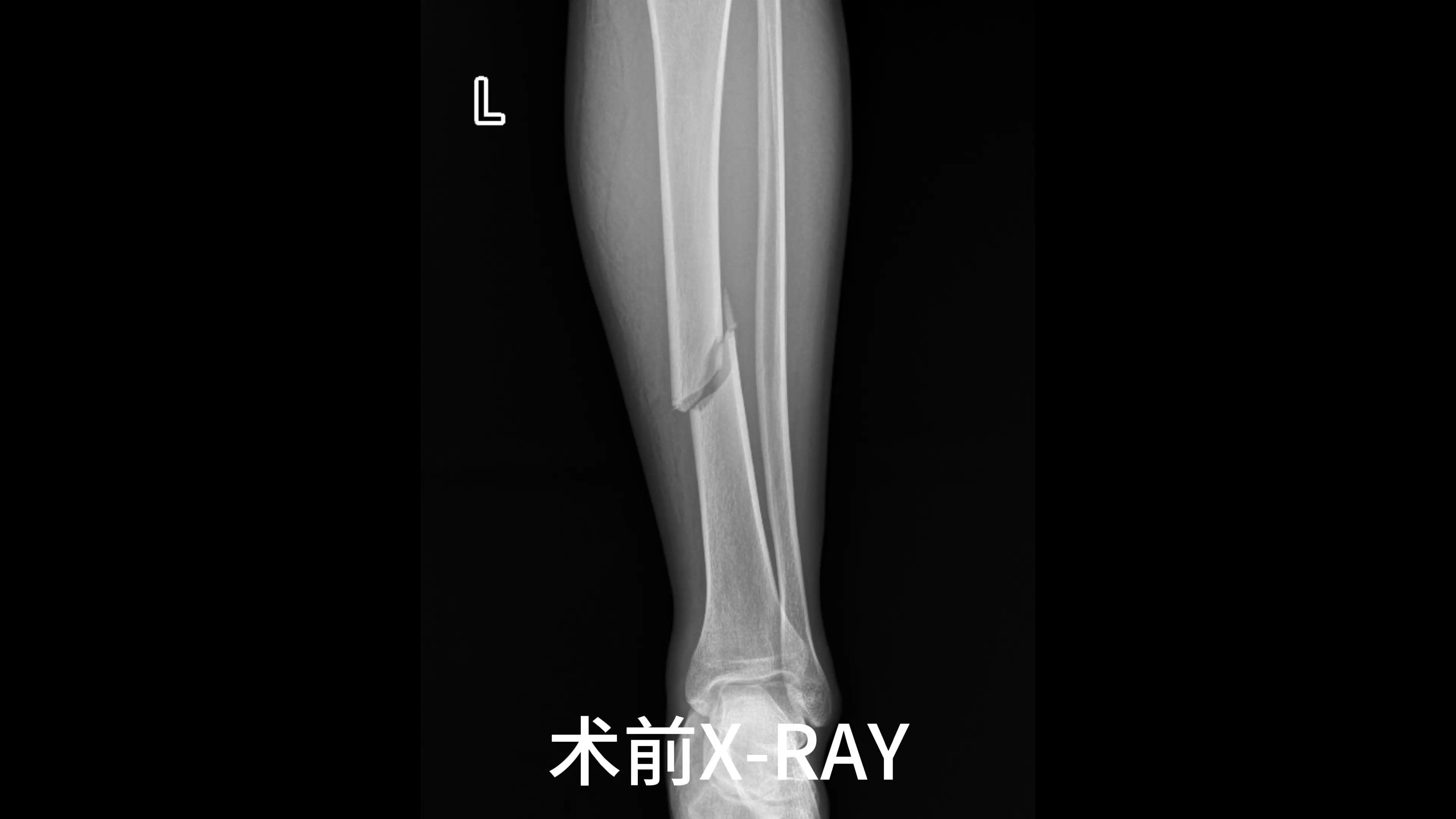 手术教学视频:胫骨骨折闭合复位髓针内固定