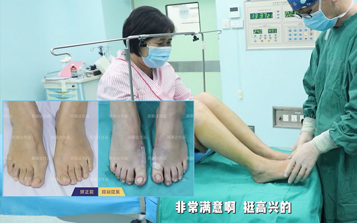 大脚骨医生苏敬达|61岁黑龙江阿姨,拇外翻治好了,多年心病解决了