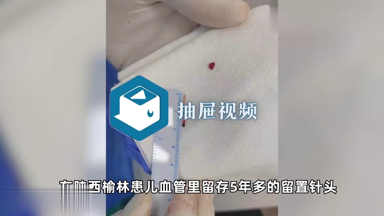 留置针头导管断在婴儿血管里随血液漂移,5年后才找到取出