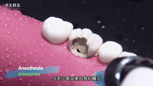 根管治疗补牙的全过程演示,小哥这技术太厉害了