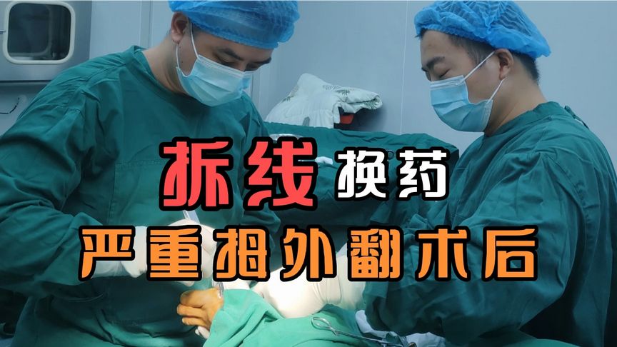 严重拇外翻术后换包扎,微创矫正,美容缝合无需拆线