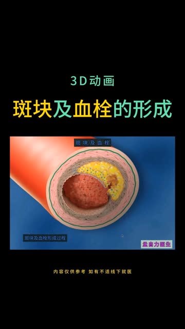 斑块及血栓如何形成? 3D动画【斑块及血栓的形成】轻松告诉您 #斑块 .