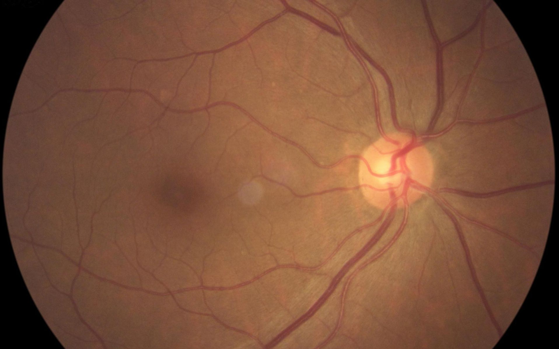 DR(糖尿病视网膜病变)数据分析