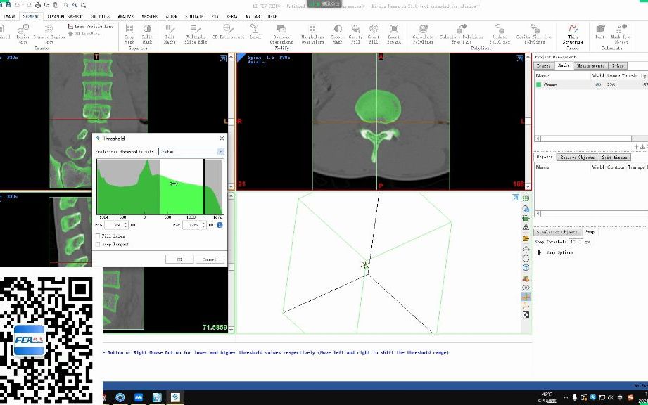 腰椎三维重建mimics脊柱3D重建