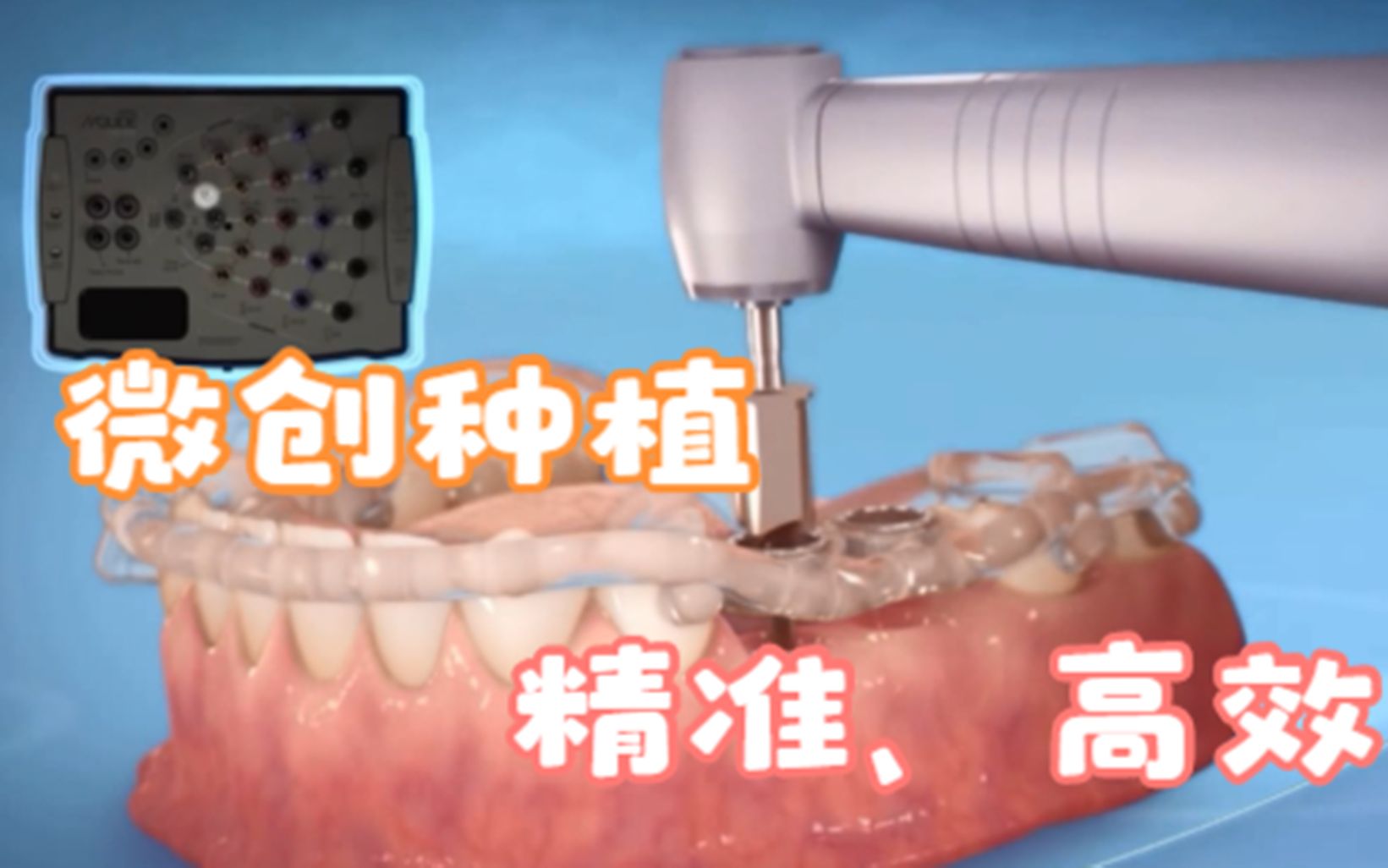 牙齿种植牙手术外挂动画视频,微创种牙精准、高效数字化种植导板