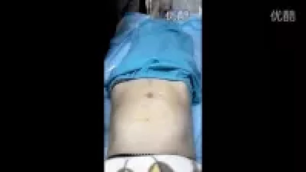 埋线针灸减肥实地操作学员录相穴位埋线疗法埋线减肥智象医疗