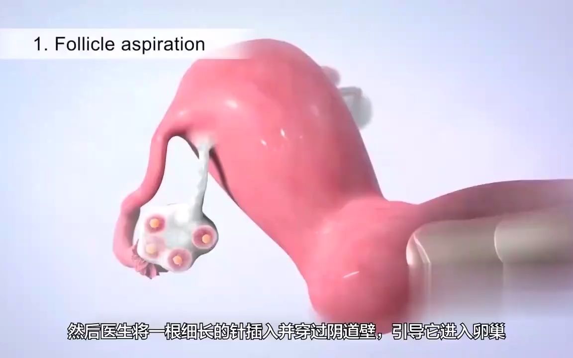 试管婴儿究竟有多疼?3D动画演示移植全过程