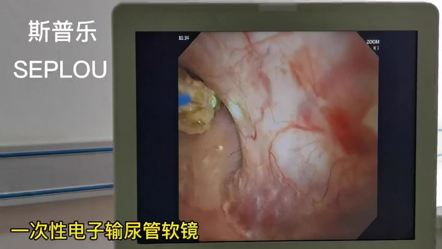 一次性电子输尿管软镜图像视频#肾结石 #软镜鞘 #结石 #斯普乐