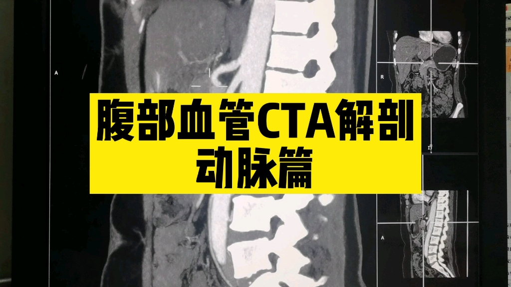 【血管基础解剖】上腹部血管动脉CTA解剖,腹腔干,肠系膜上动脉,肠...