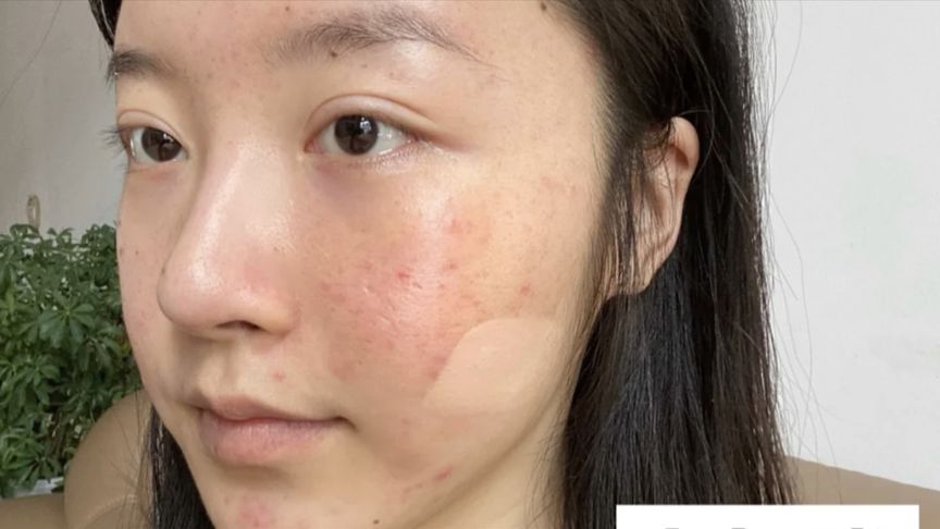 洁肤霜真的能洗干净?别傻了!用法不当易烂脸,可千万别大意!