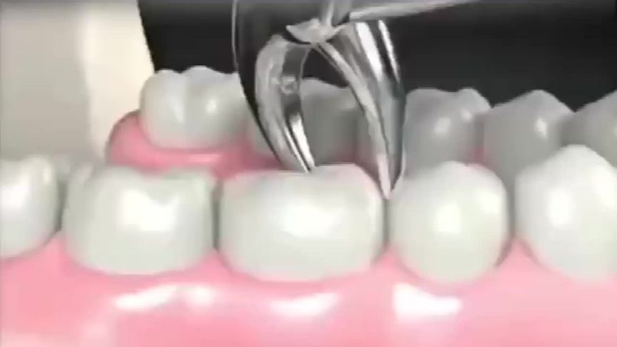 18秒带你看完种植牙过程