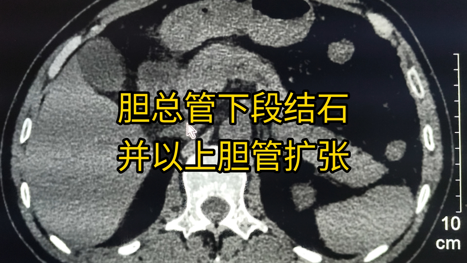 胆总管下段结石并以上胆管扩张
