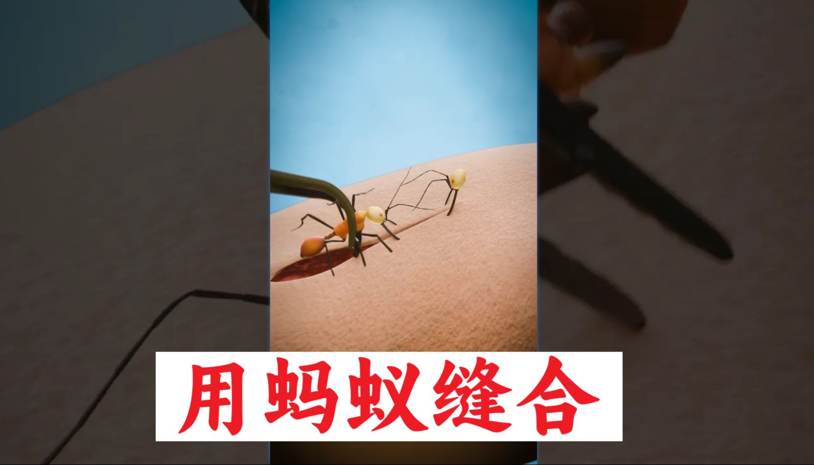 没有缝合线时可以用蚂蚁缝合伤口【医学科普】