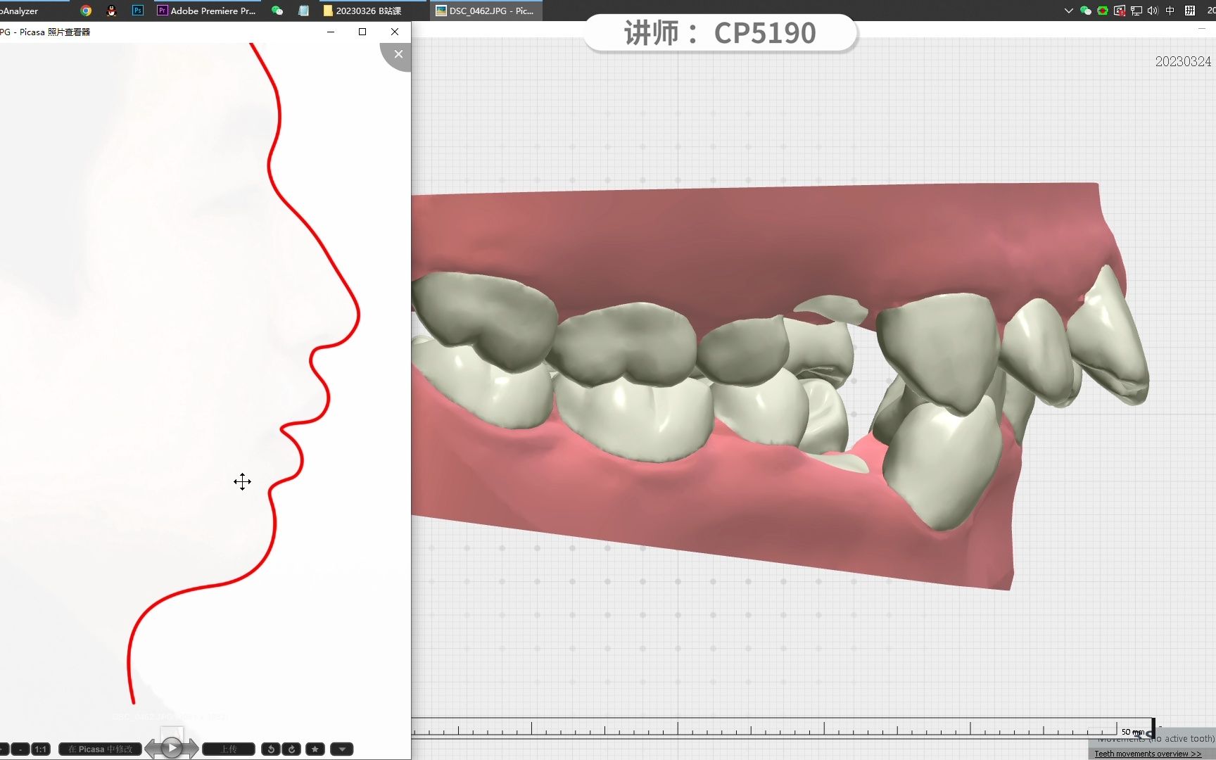 3shape隐形牙套设计,纯正案例分析,干货不放水,Orthoanalyzer思路讲解...